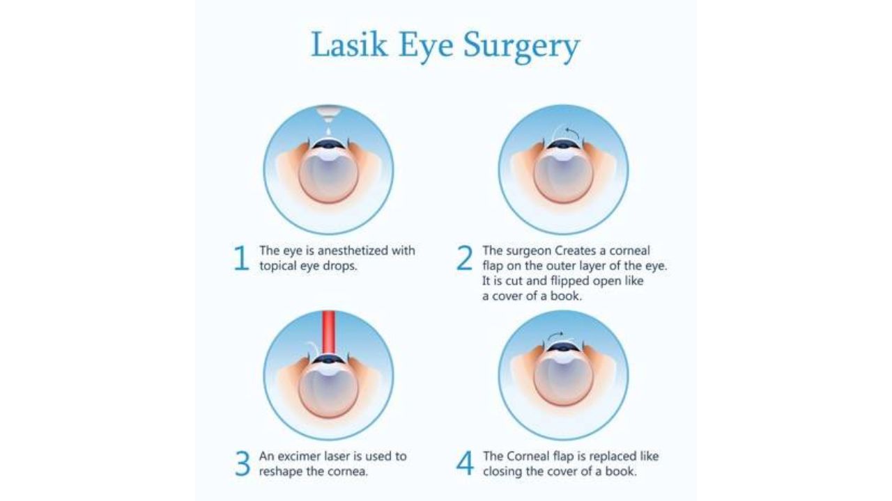 LASIK (Laser-Assisted In Situ Keratomileusis) – Pump Industry
